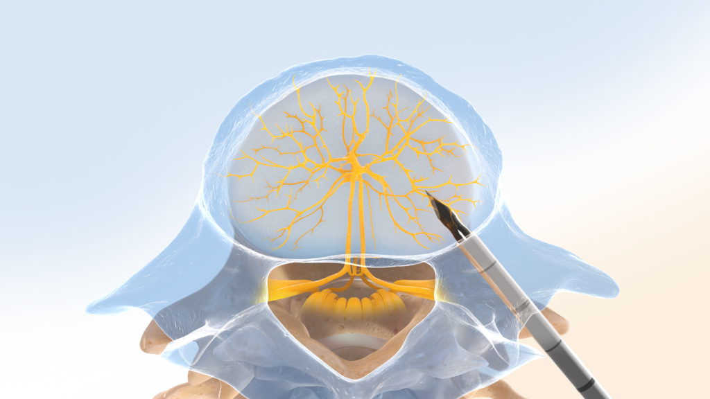 Intracept® Procedure - North Texas Orthopedic & Spine Center