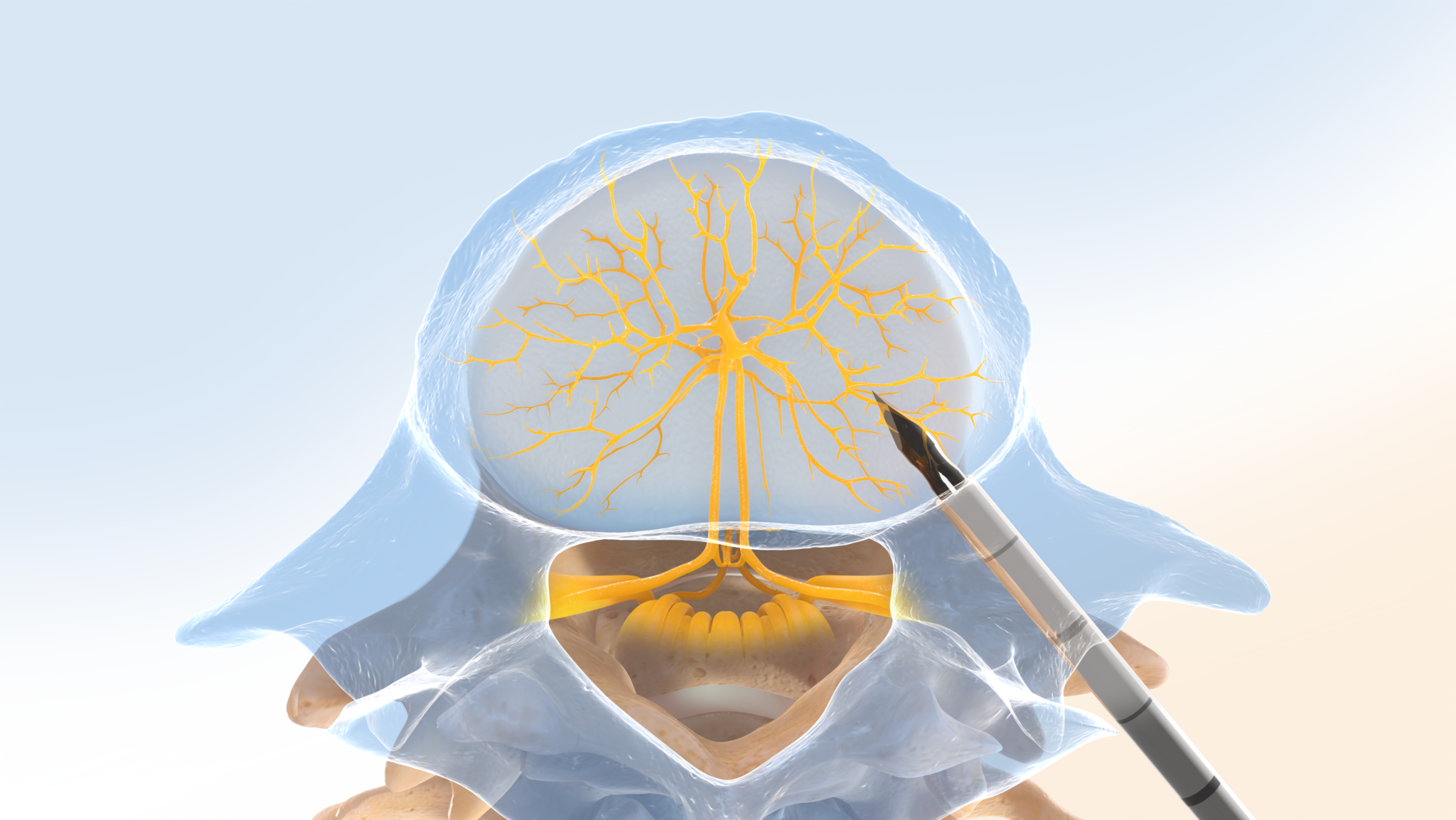 Intracept® Procedure - North Texas Orthopedic & Spine Center