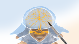 Intracept® Procedure - North Texas Orthopedic & Spine Center