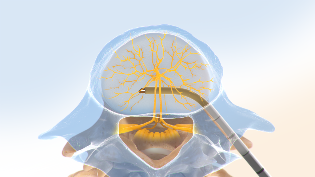 Intracept® Procedure - North Texas Orthopedic & Spine Center