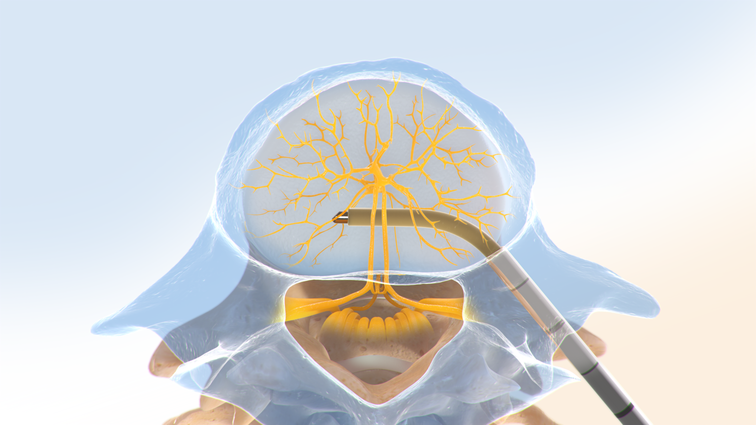 Intracept® Procedure - North Texas Orthopedic & Spine Center