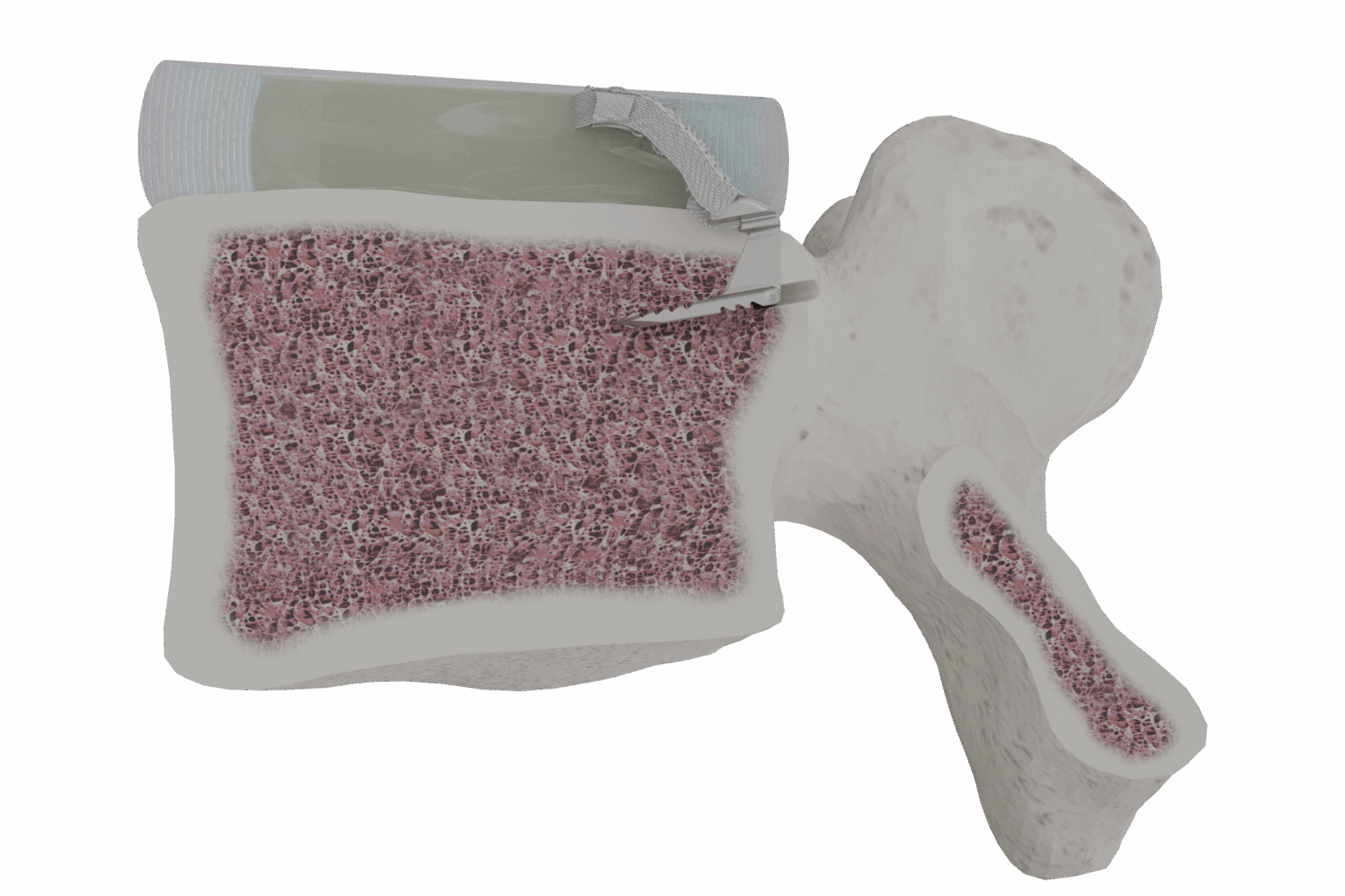 Barricaid® Procedure - North Texas Orthopedic & Spine Center