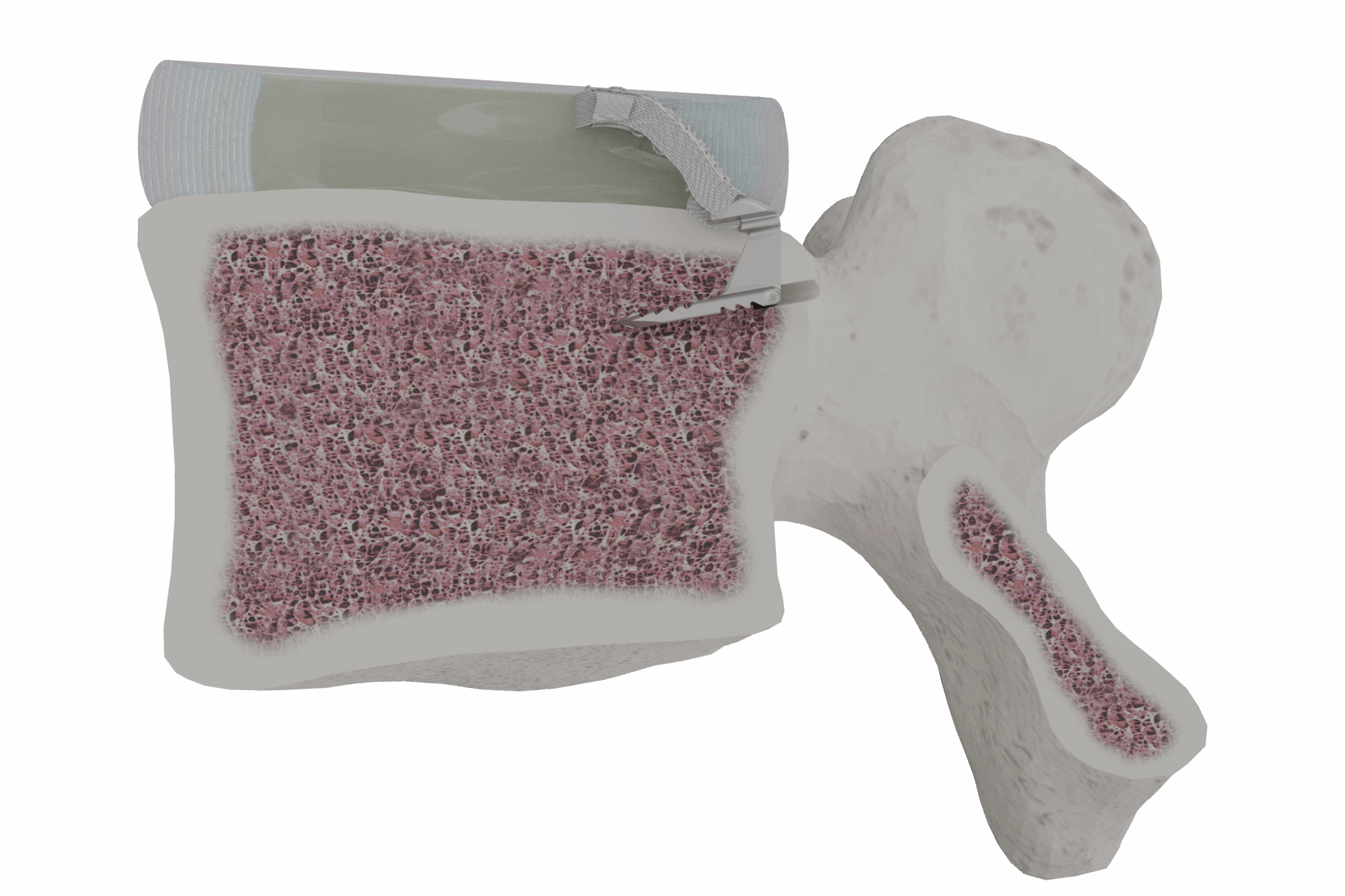 Barricaid® Procedure - North Texas Orthopedic & Spine Center