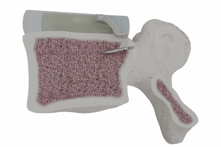 Barricaid® Procedure - North Texas Orthopedic & Spine Center